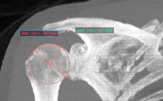 Upper Limb | Shoulder Resurfacing: How to perform