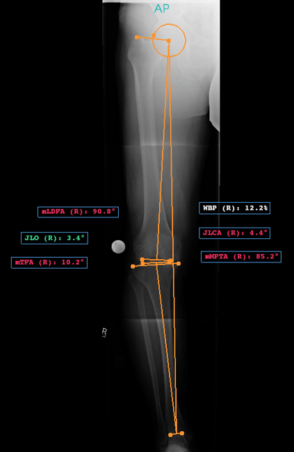 Knee Osteotomy: How to perform