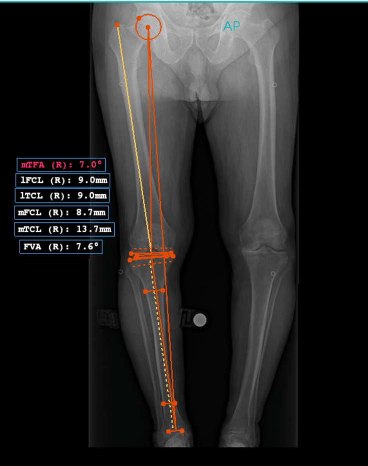 Knee | Total Knee Arthroplasty: How to perform