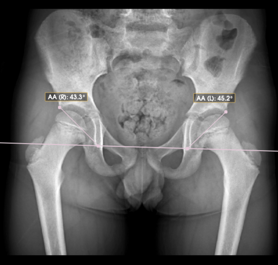 Pediatrics | Acetabular Angle: How to perform
