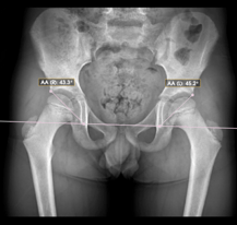 Pediatrics | Acetabular Angle: How to perform