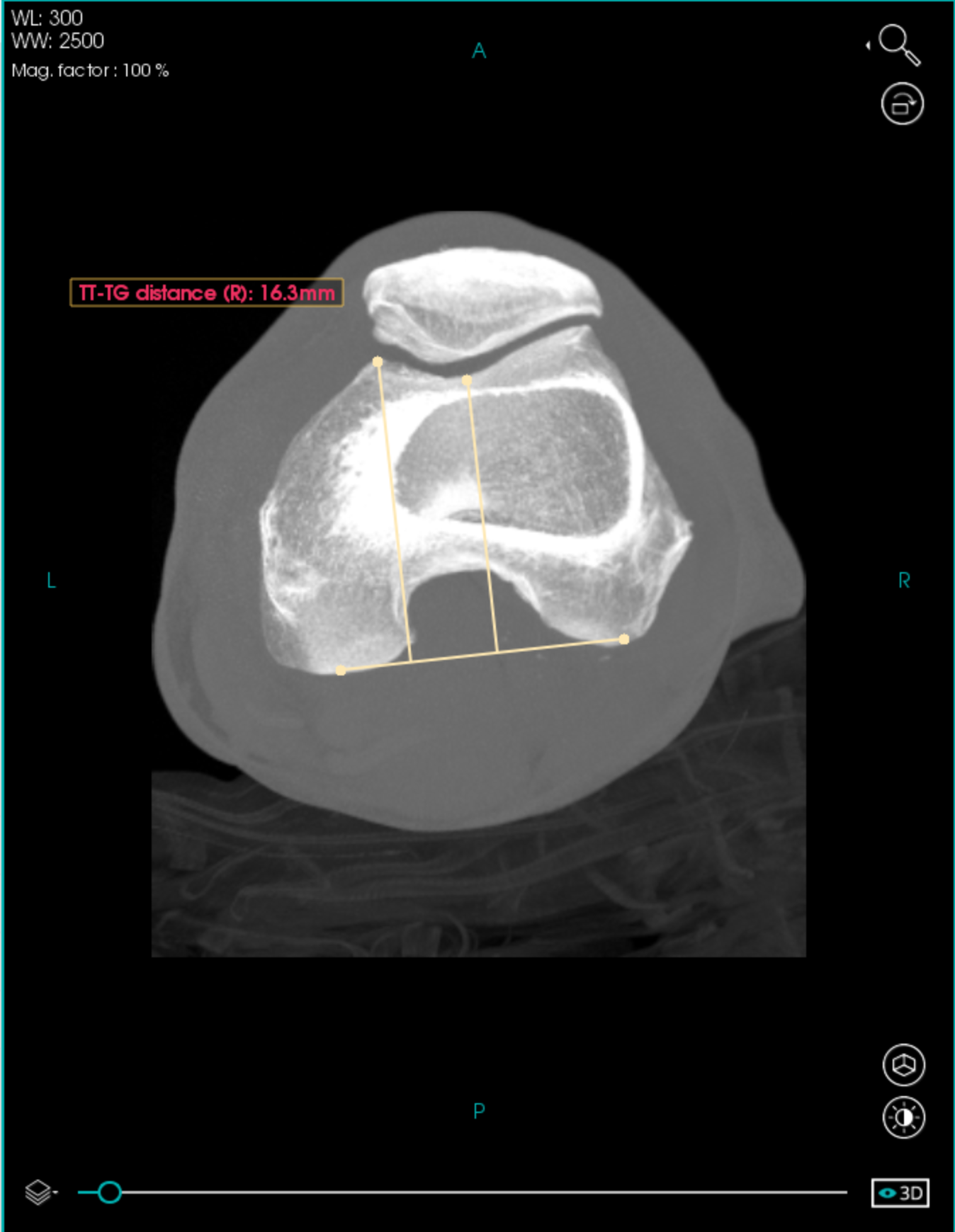 Knee | TT-TG distance: How to perform