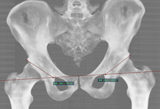 Hip | Acetabular Angle: How to perform