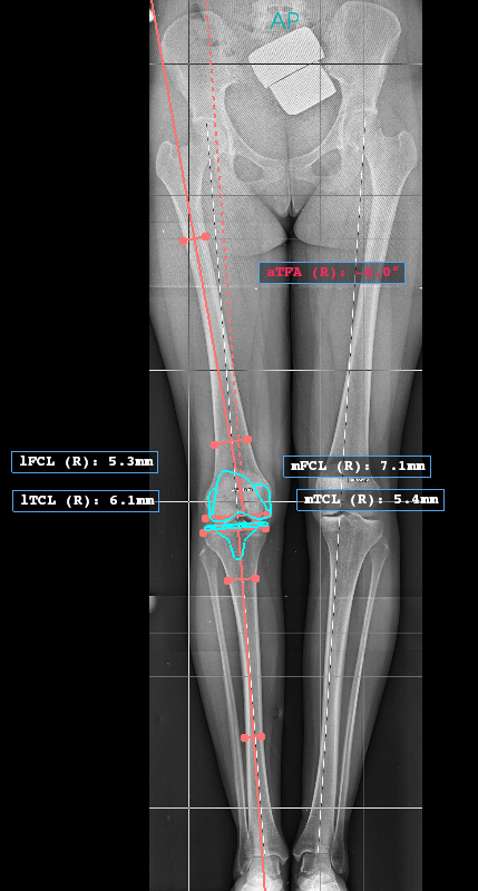 Knee | AP Knee Resection: How to perform