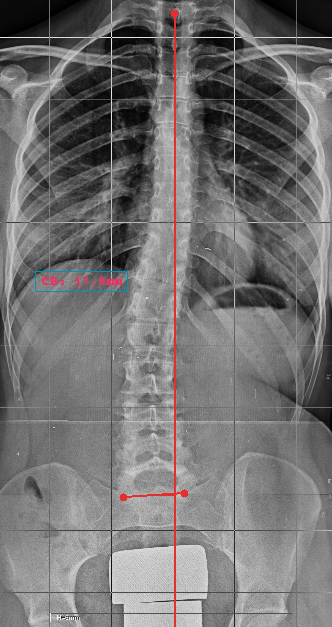 Coronal Balance: How to perform