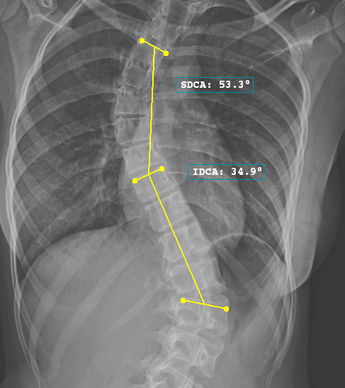 Spine | Double Cobb Angle: How to perform