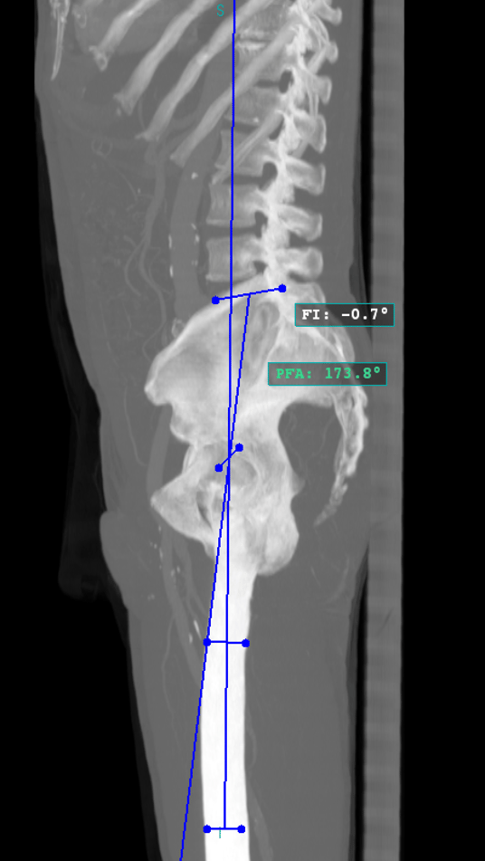 Spine | Femoral Angles: How to perform