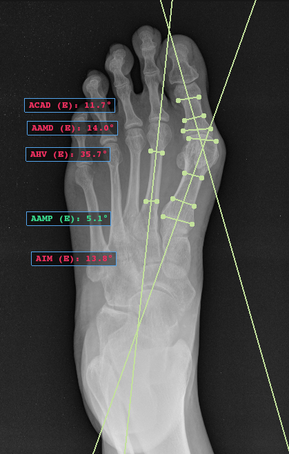Hallux Valgus: Como realizar