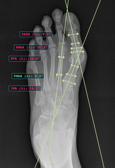 Foot and Ankle | Hallux Valgus: How to perform