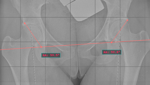 Acetabular Angle: How to perform