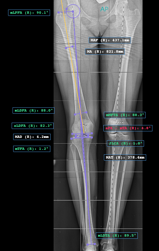 Leg Deformity Correction: How to perform
