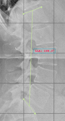 Spine | Lumbar Lordosis Angle: How to perform