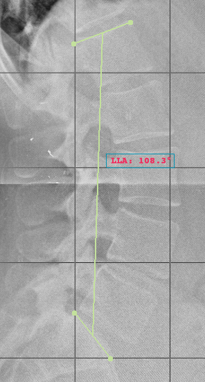 Lumbar Lordosis Angle How To Perform