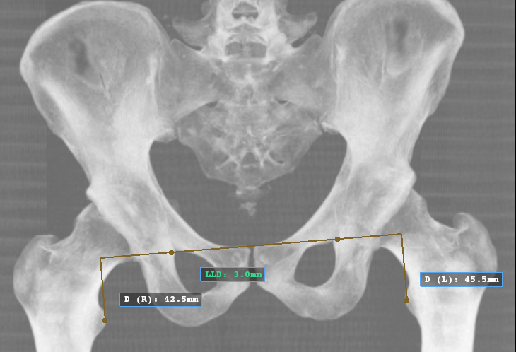 Hip | Limb Length Discrepancy: How to perform