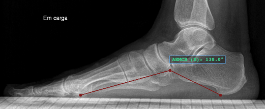 Ângulo Externo Moreau-Costa-Bertani: Como realizar