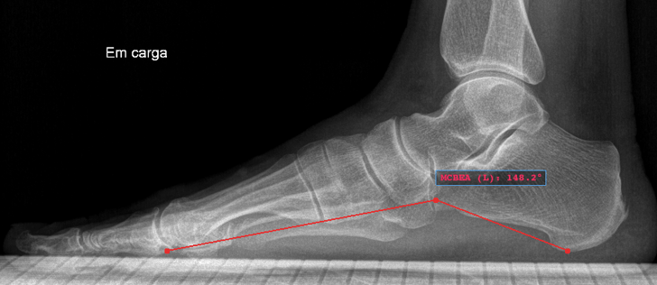 Foot and Ankle | Moreau-Costa-Bertani External Angle: How to perform