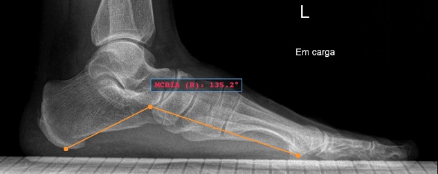 Foot and Ankle | Moreau-Costa-Bertani Internal Angle: How to perform