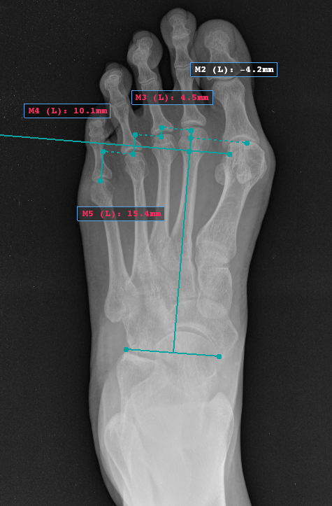 Foot and Ankle | Maestro Formula: How to perform