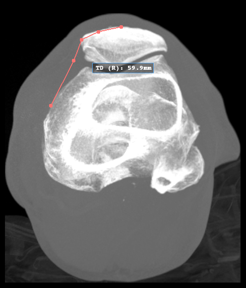 Knee | Medial patellofemoral ligament: How to perform