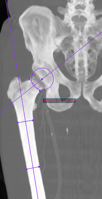 Hip | Proximal Femoral Osteotomy: How to perform