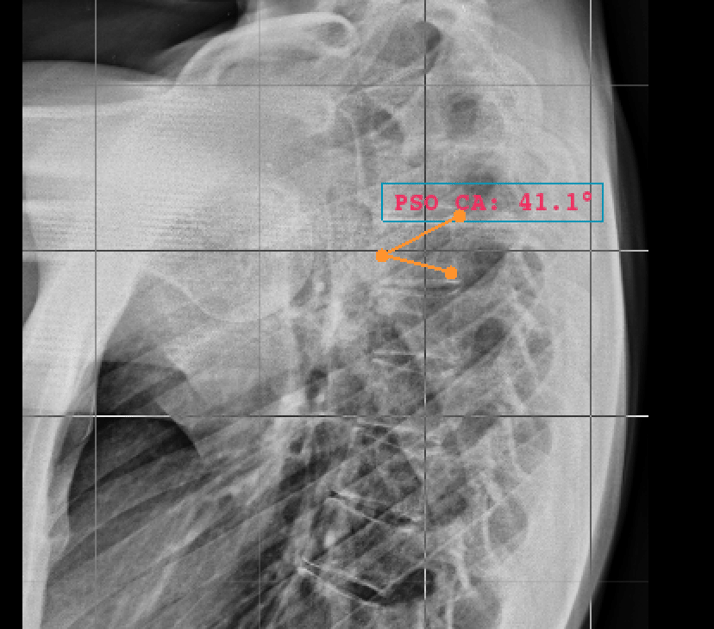 Spine | Pedicle Subtraction Osteotomy: How to perform