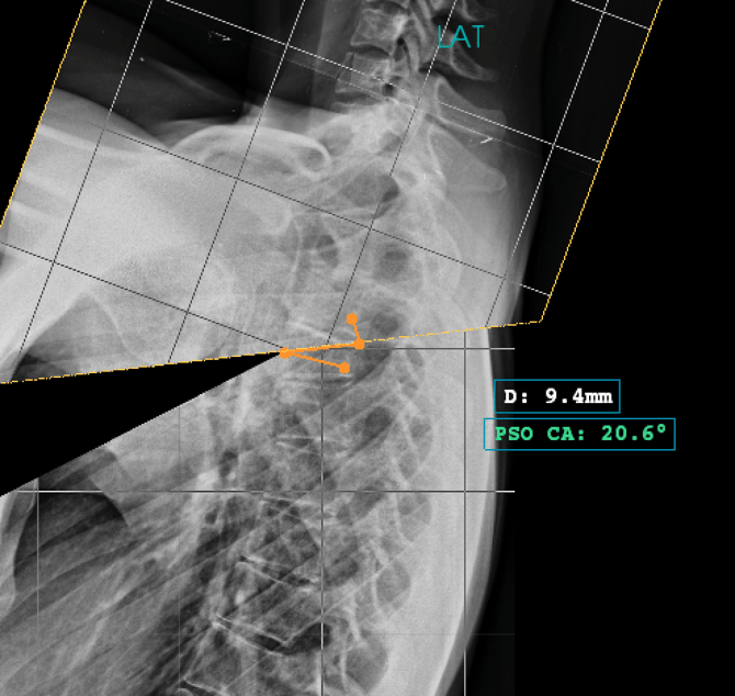 Spine | Pedicle Subtraction Osteotomy: How to perform
