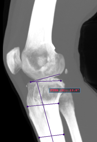 Knee | Posterior Tibial Slope Correction: How to perform