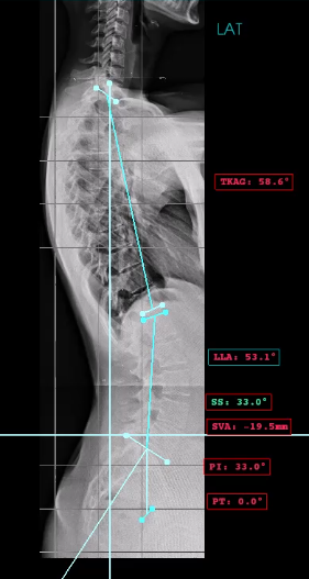 Spine | Sagittal Balance: How to perform