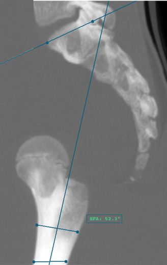 Sacro-Femoral Angle: How to perform