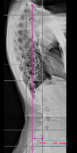 Spine | Sagittal Vertical Axis: How to perform