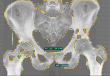 Total Hip Arthroplasty: How to perform