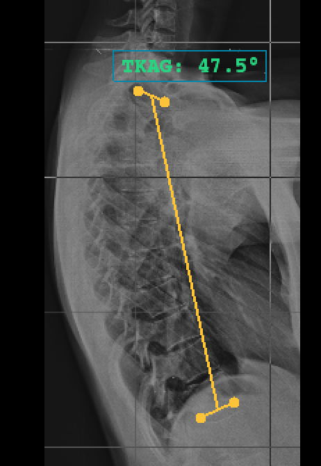 Spine | Thoracic Kyphosis Angle: How to perform