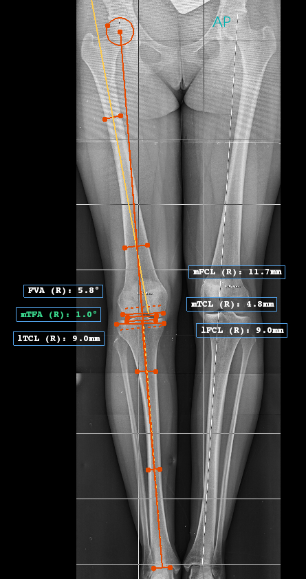 Total Knee Arthroplasty: How to perform