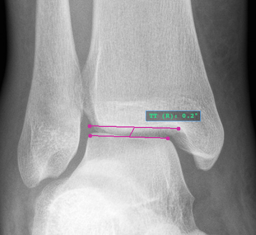 Foot and Ankle | Talar Tilt: How to perform
